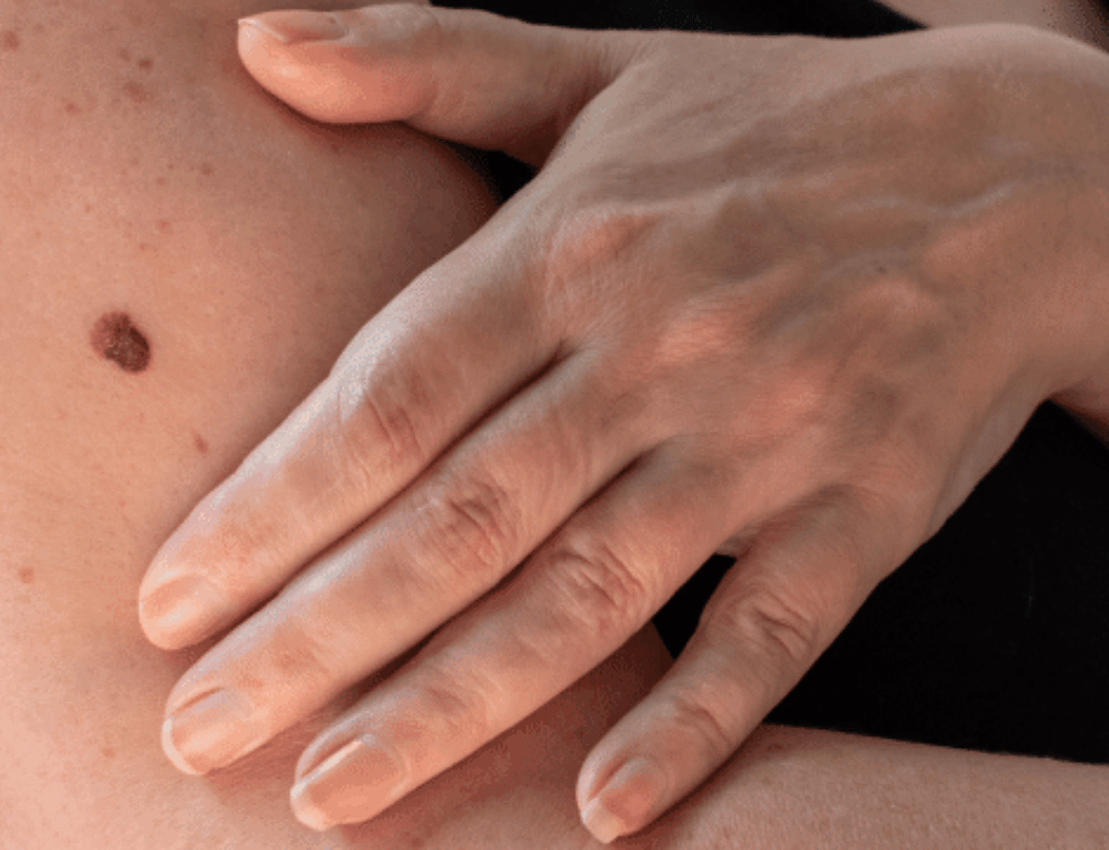 How to Get Rid of Post-Inflammatory Hyperpigmentation (PIH) - Art of ...